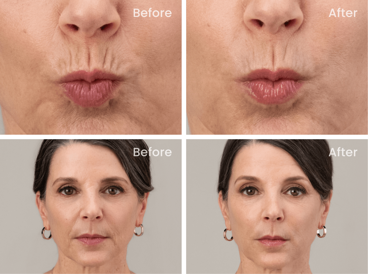 What is RHA Redensity Facial Filler