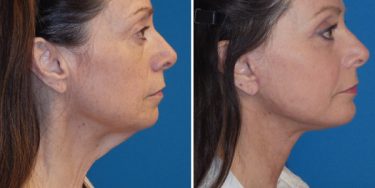 Kybella Injections - Redondo Beach, Hermosa Beach, Torrance