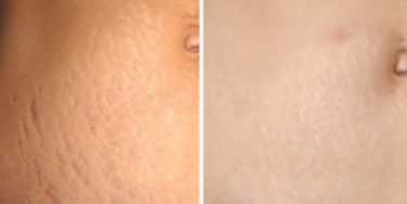 Microneedling Treatment for Stretch Marks - Redondo Beach