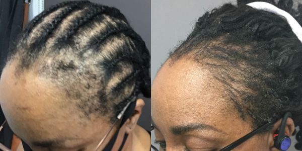 PRF Hair Restoration-Redondo, Hermosa, Torrance, Palos Verdes