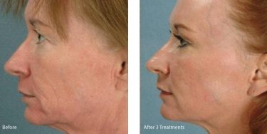 PRF Injections for Face-Redondo, Hermosa, Torrance, Palos Verdes