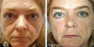 PRF Injections for Face-Redondo, Hermosa, Torrance, Palos Verdes