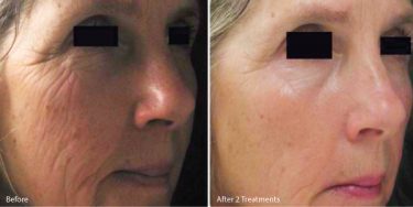PRF Injections for Face-Redondo, Hermosa, Torrance, Palos Verdes