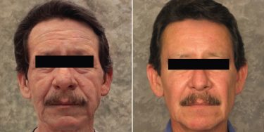 PRF Injections for Face-Redondo, Hermosa, Torrance, Palos Verdes