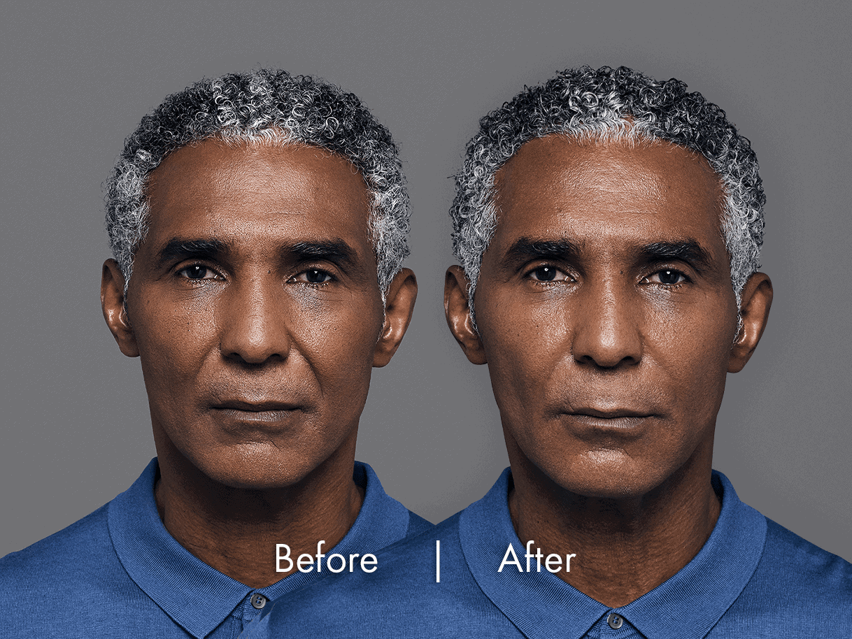 The New RHA Fillers are Here - Redondo Beach