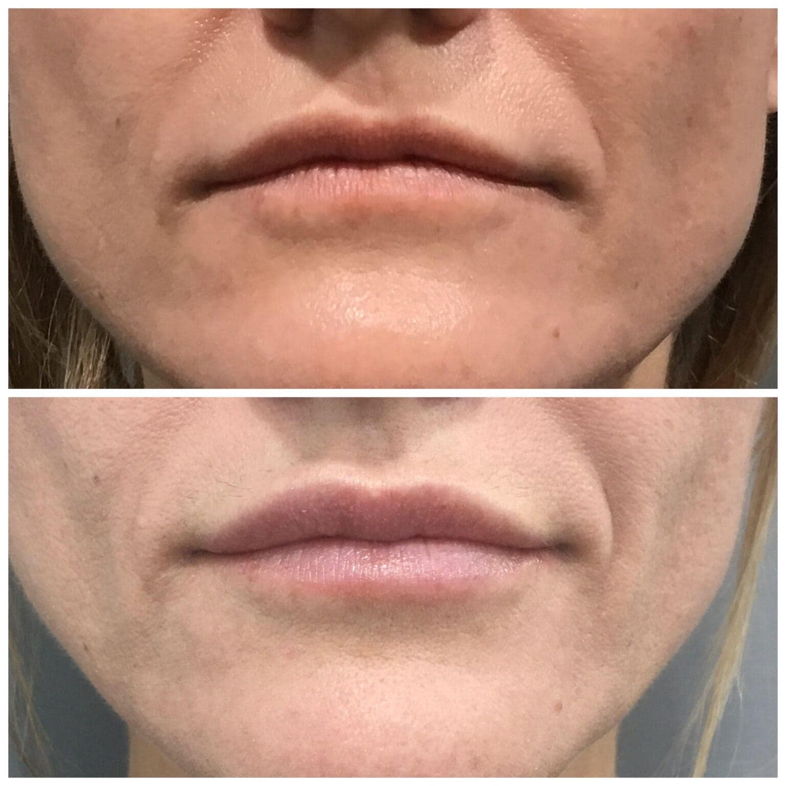 The New RHA Fillers are Here - Redondo Beach