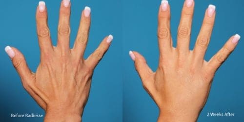 How to Reduce the Look of Aging Hands - The Laser Image Company