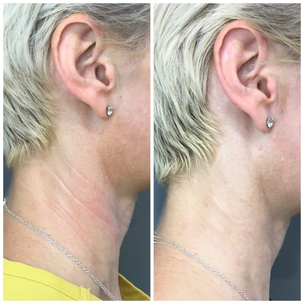 RHA Filler Redensity - Redondo, Hermosa, Torrance, Palos Verdes