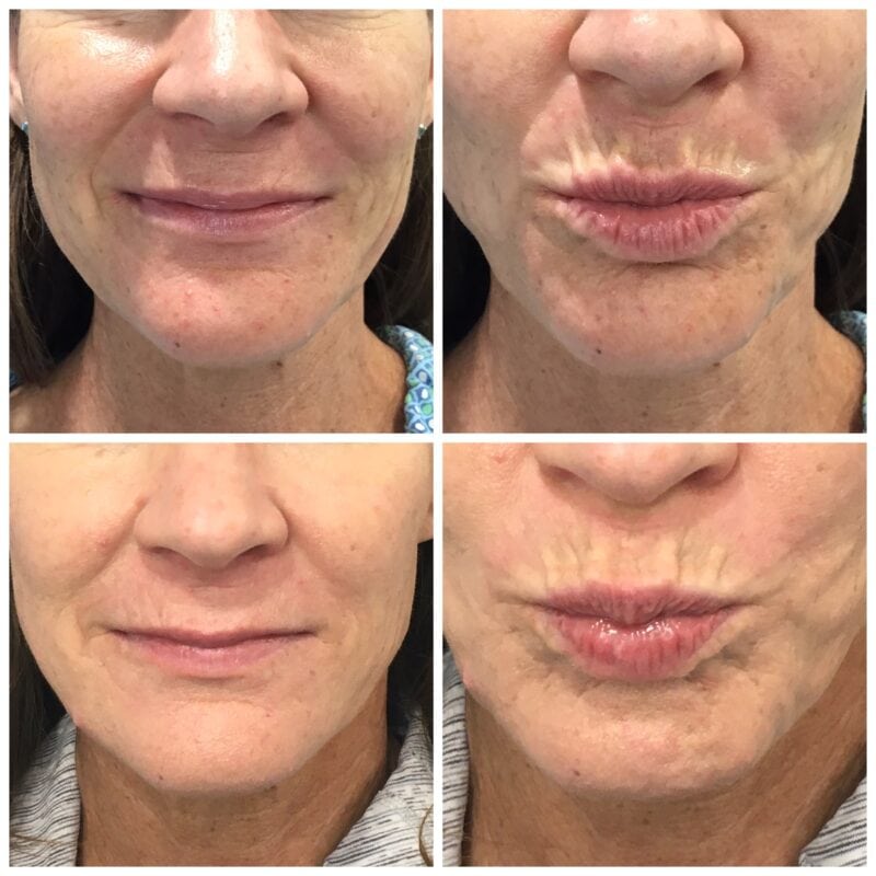 RHA Filler Redensity - Redondo, Hermosa, Torrance, Palos Verdes