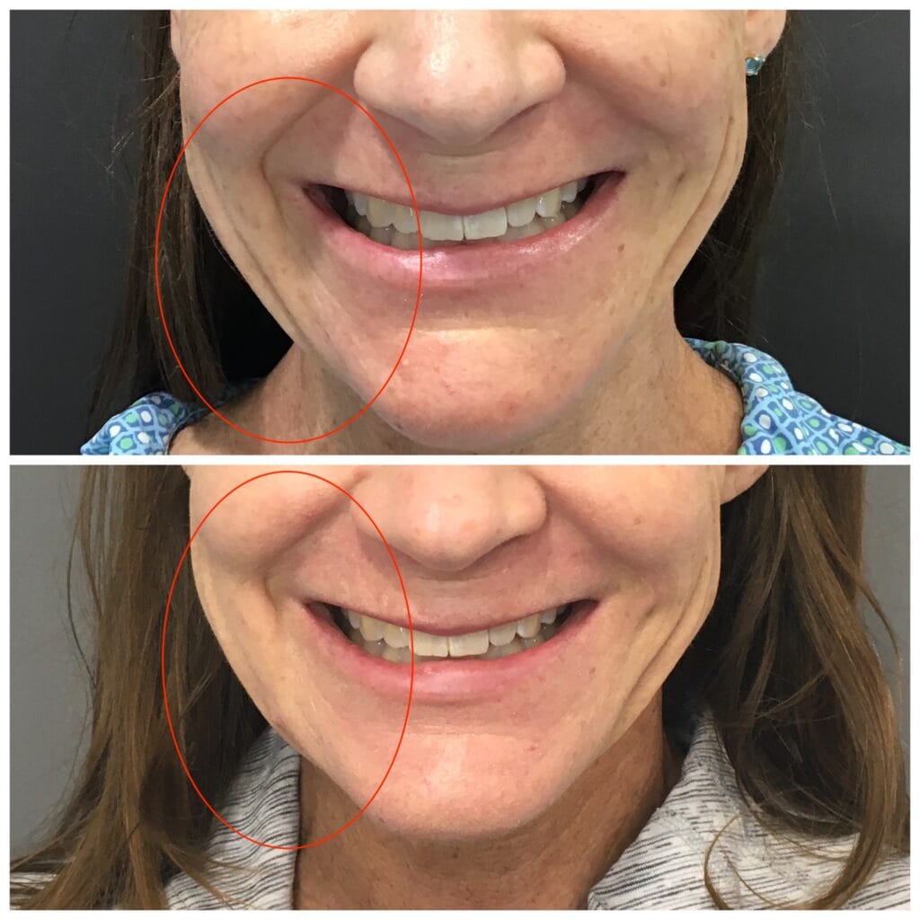 What is RHA Redensity Facial Filler