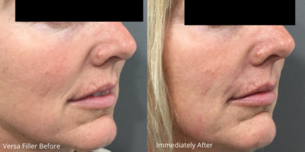 Versa Filler-Redondo Beach, Hermosa Beach, Torrance, Palos Verdes