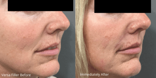 Versa Filler-Redondo Beach, Hermosa Beach, Torrance, Palos Verdes