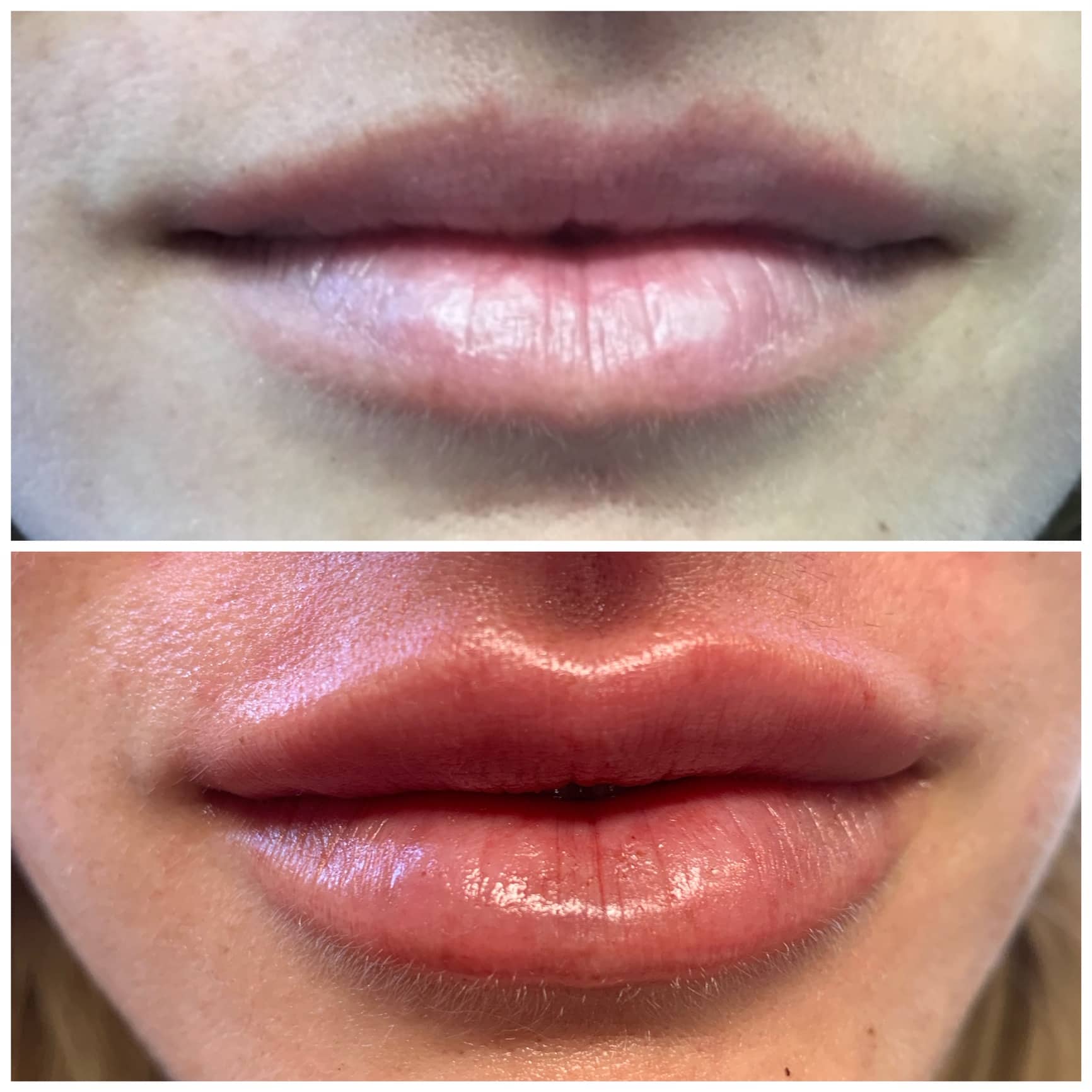 Lip Filler Before & After Photos - The Laser Image Company - South Bay