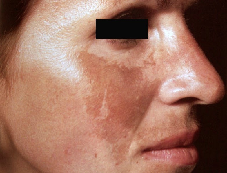 Hyperpigmentation – Learn how to better brighten your melasma
